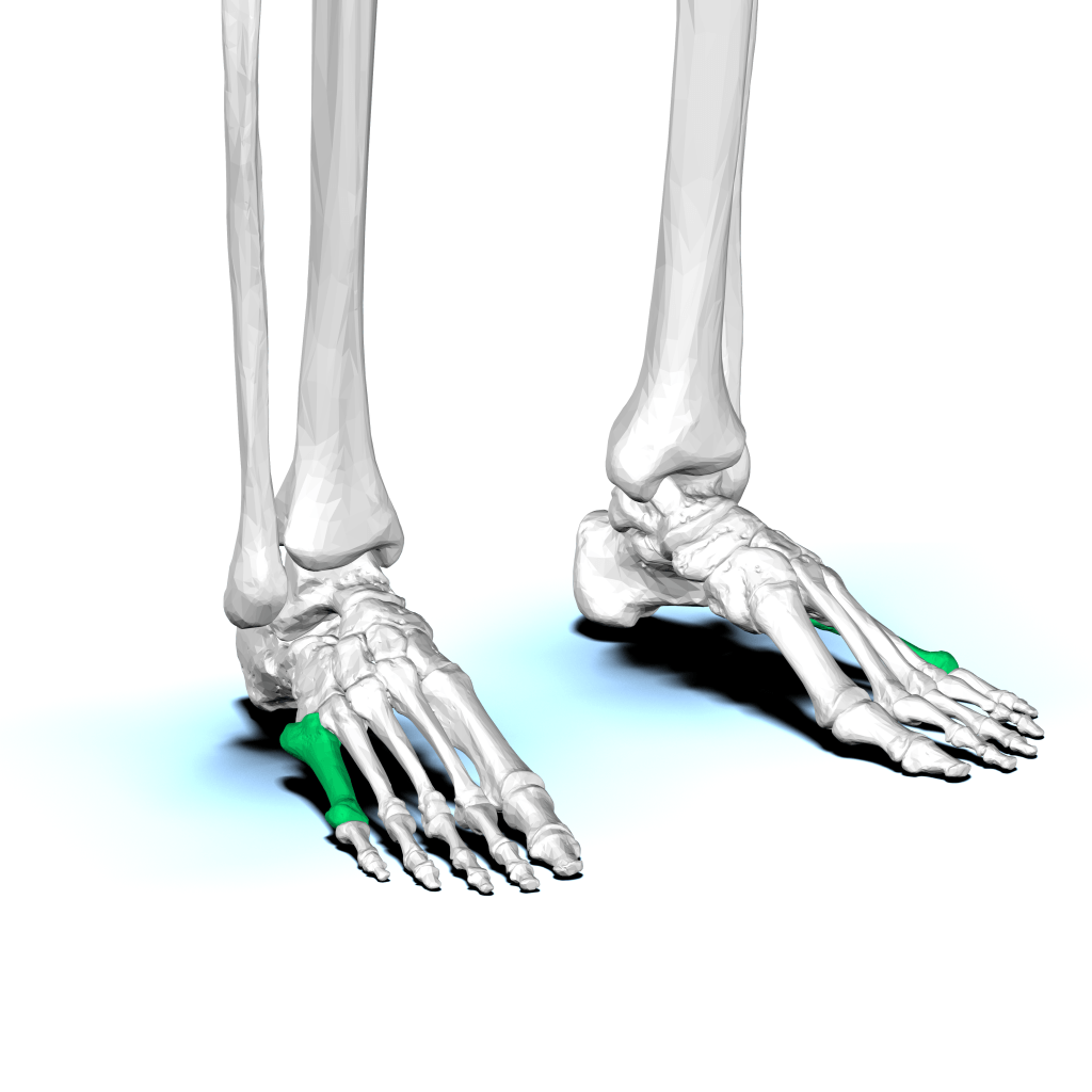 Do You Need Metatarsal Surgery? - Cherrywood Foot Care