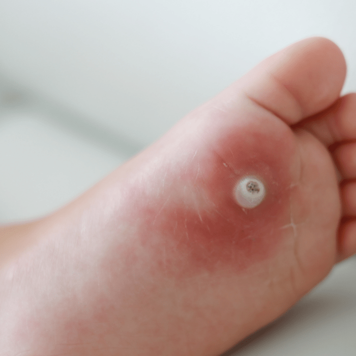 Wart Treatment - Cherrywood Foot Care
