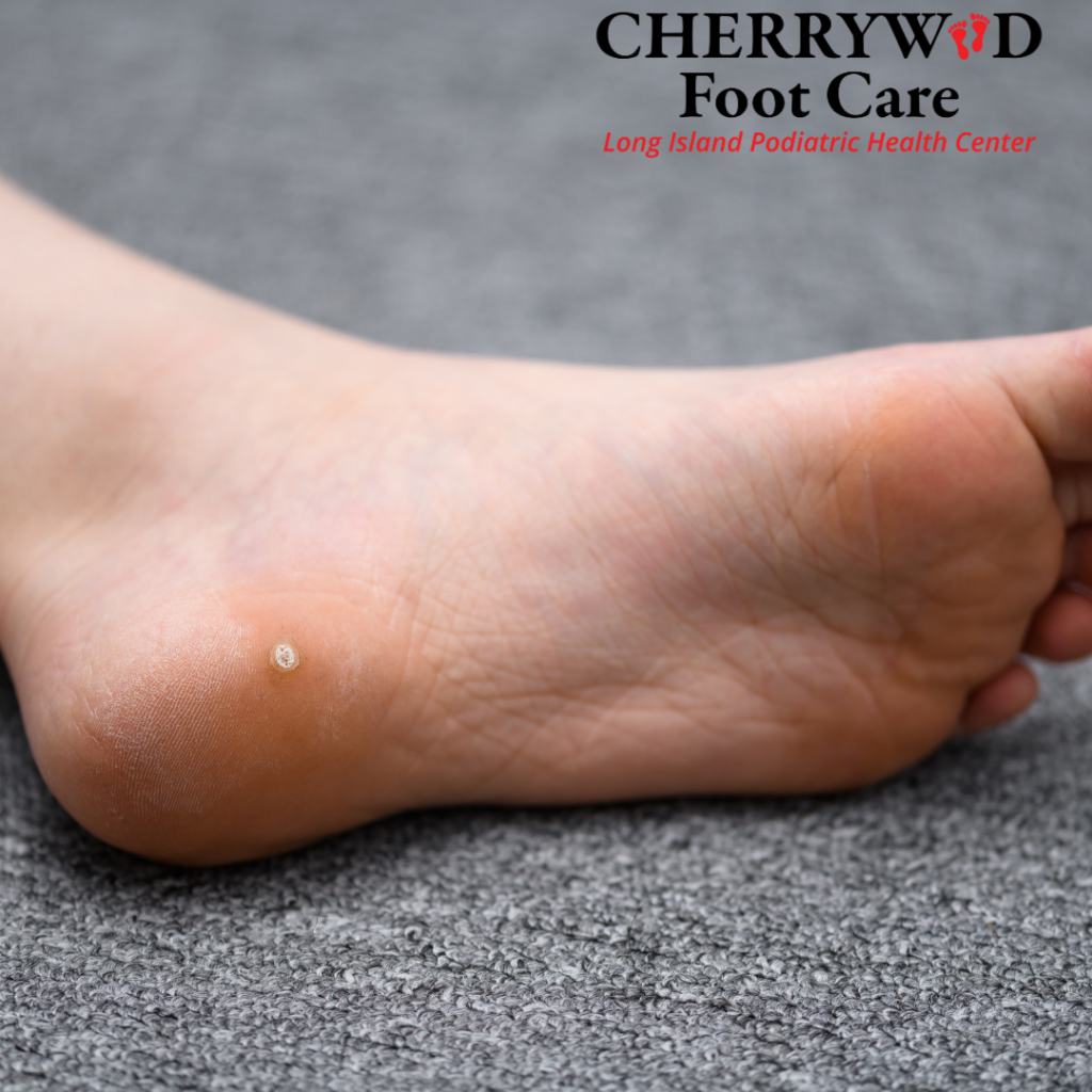 Preventing Plantar Warts - Cherrywood Foot Care